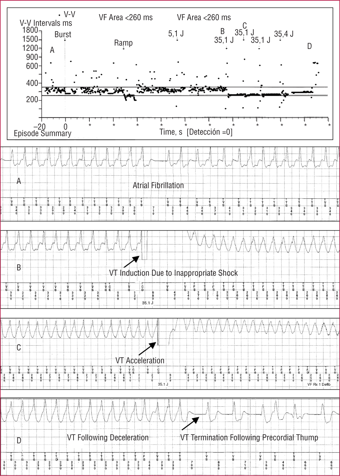 Life-Threatening Implantable Defibrillator-Induced Proarrhythmia ...