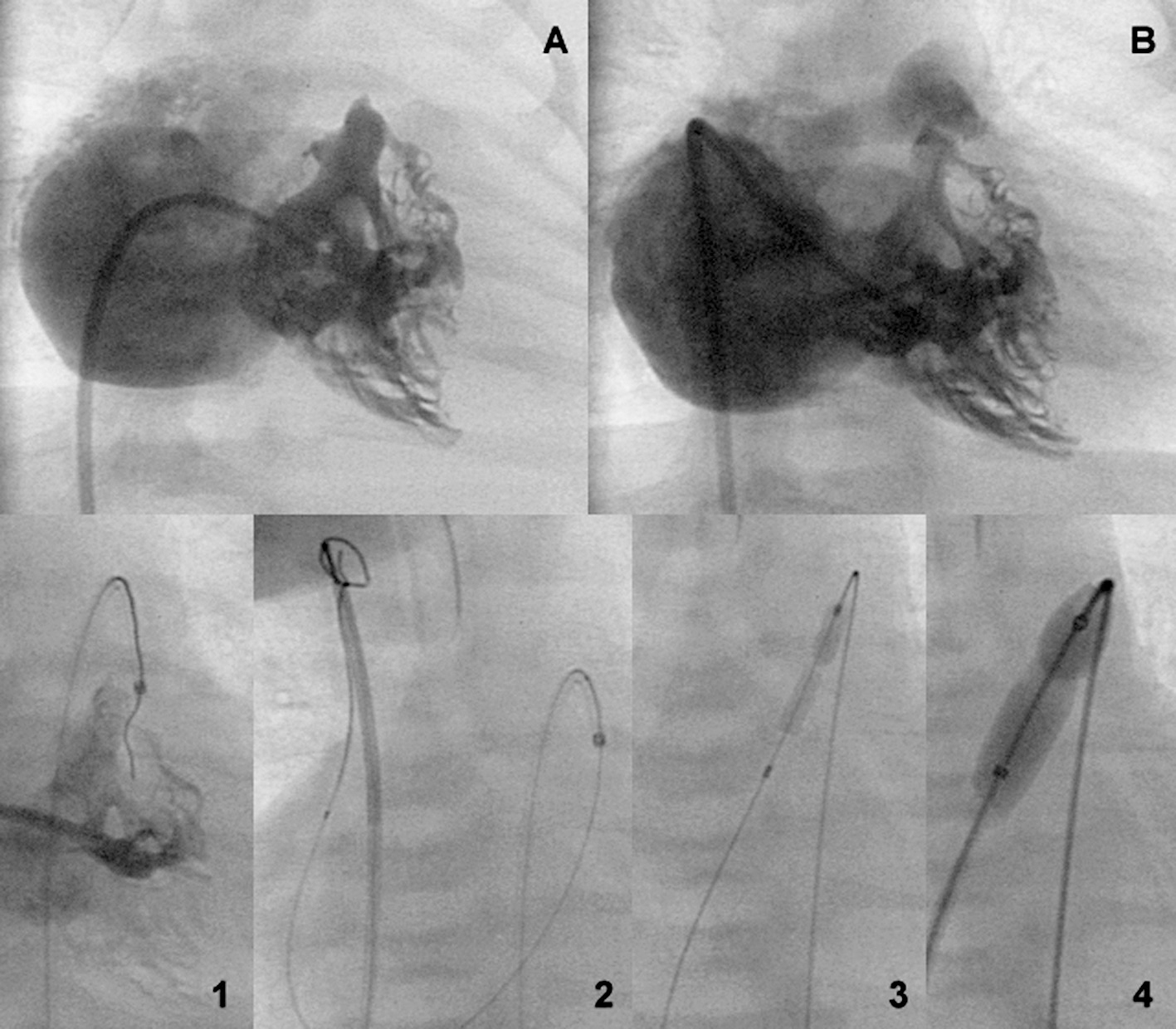 Pulmonary Atresia With Intact Ventricular Septum. Perforation and ...