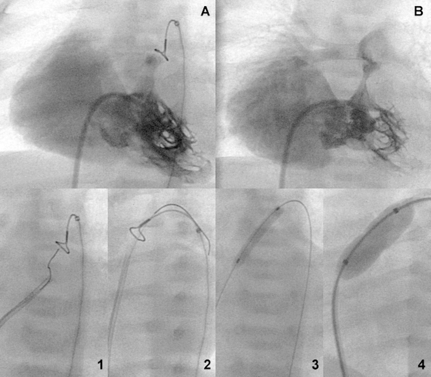 Pulmonary Atresia With Intact Ventricular Septum. Perforation and ...