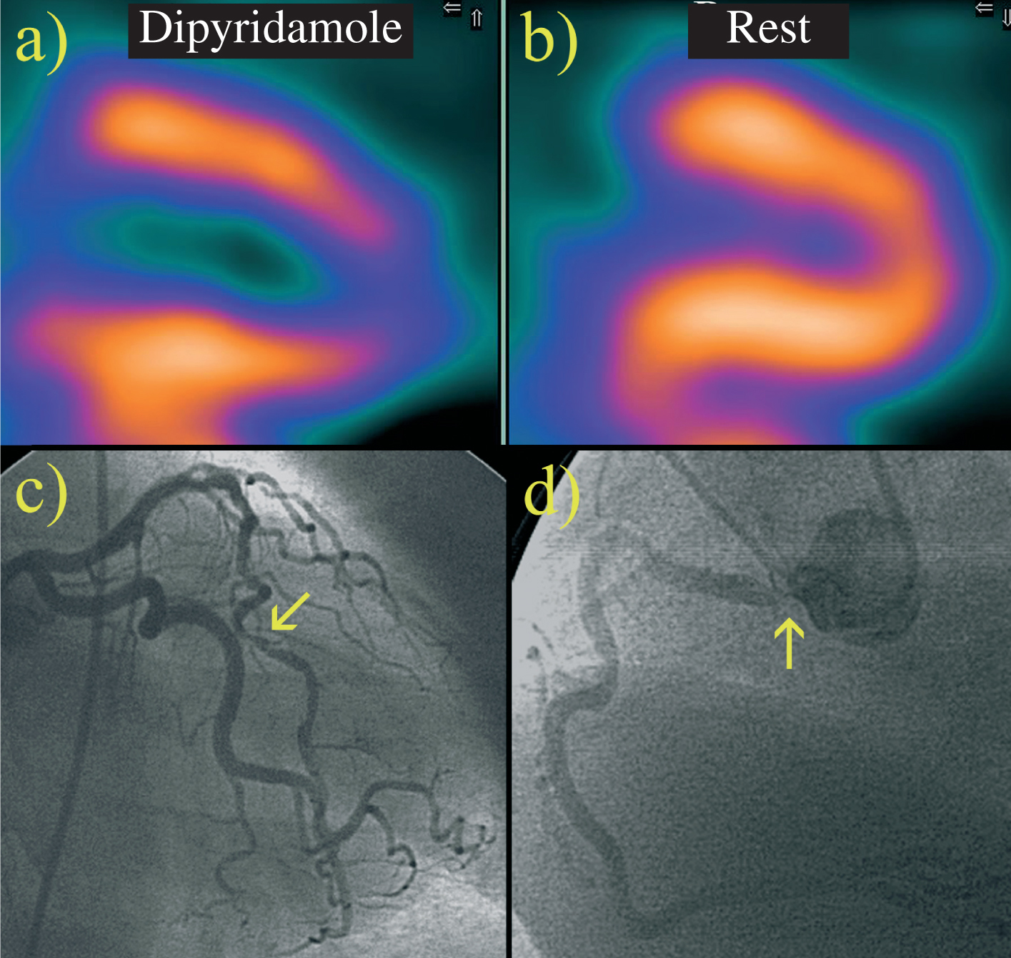 Collateral Circulation Due to Persistent Myocardial Sinusoids | Revista ...
