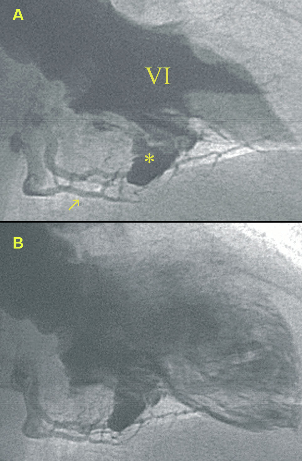 Collateral Circulation Due to Persistent Myocardial Sinusoids | Revista ...