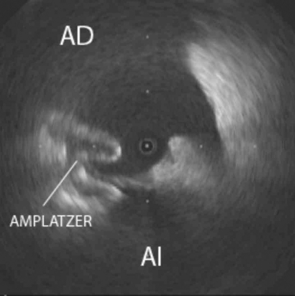 Iatrogenic Atrial Septal Defect: Intracardiac Ultrasound-Guided ...