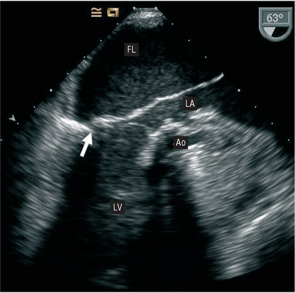 Left Atrial Dissection Due to Left Ventricular Rupture After Mitral ...