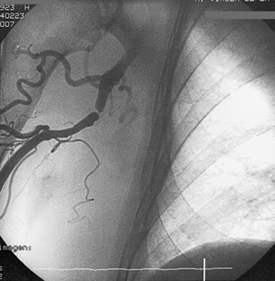 Peripheral Arterial Disease and Coronary Angiography: Forging a Path ...
