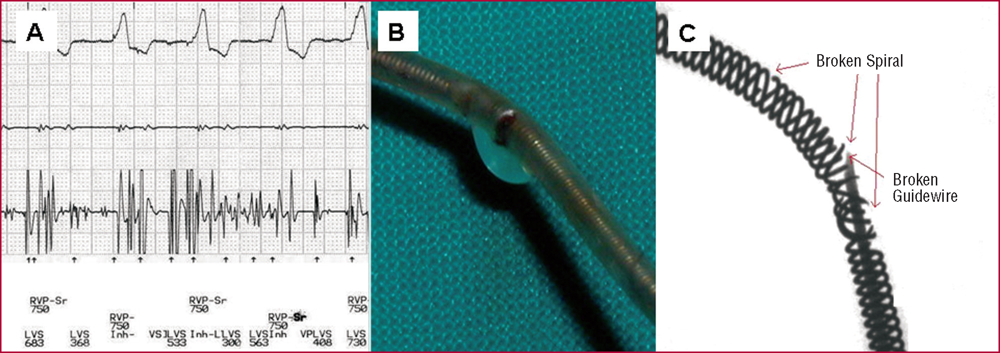 Late Failure of Left Ventricular Leads Stabilized Using the Retained ...