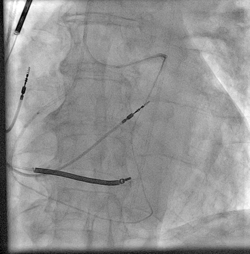 Retrograde Angioplasty in Chronic Total Occlusion | Revista Española de ...