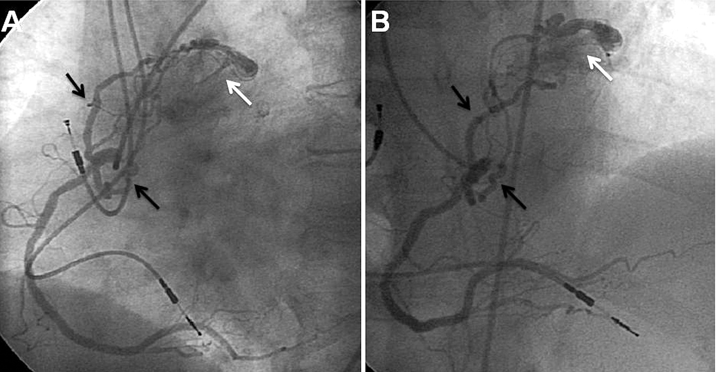 Transcatheter Closure of a Complex Fistula From the Right Coronary ...