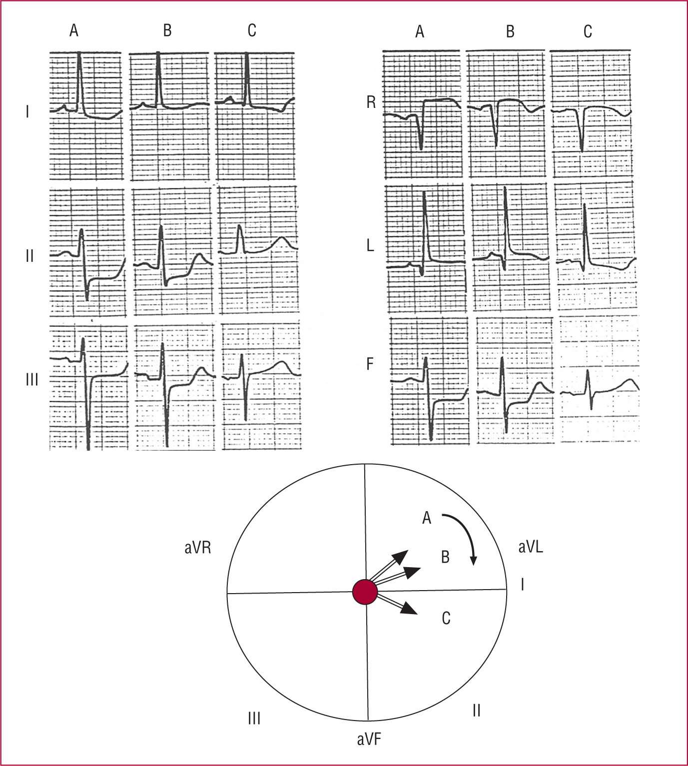 Electrocardiographic Diagnosis of Left Main Coronary Artery Obstruction ...