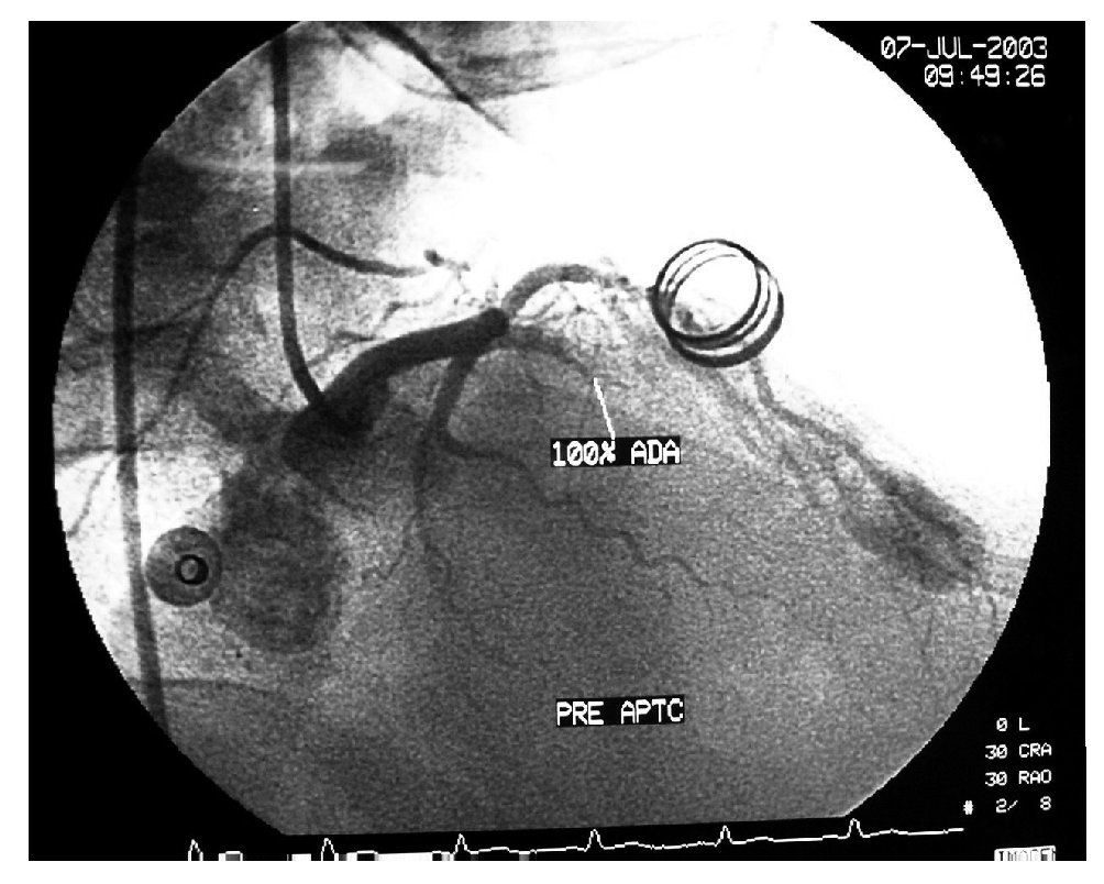 Subacute Stent Thrombosis in a Patient With Idiopathic Thrombocytopenic ...