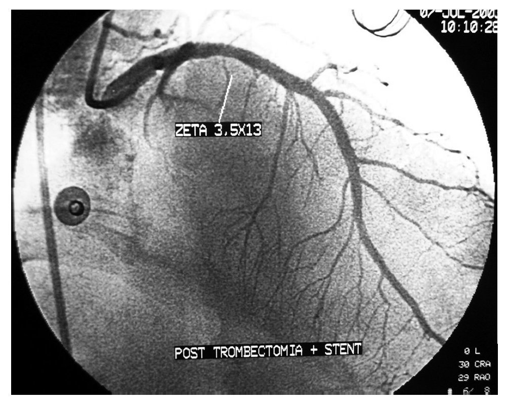 Subacute Stent Thrombosis in a Patient With Idiopathic Thrombocytopenic ...