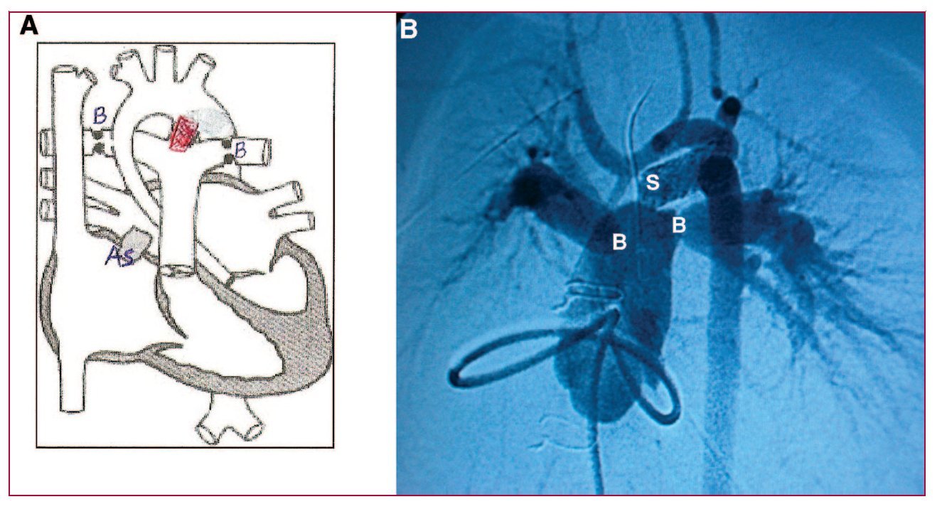 A Hybrid Approach to Hypoplastic Left Heart Syndrome | Revista Española ...