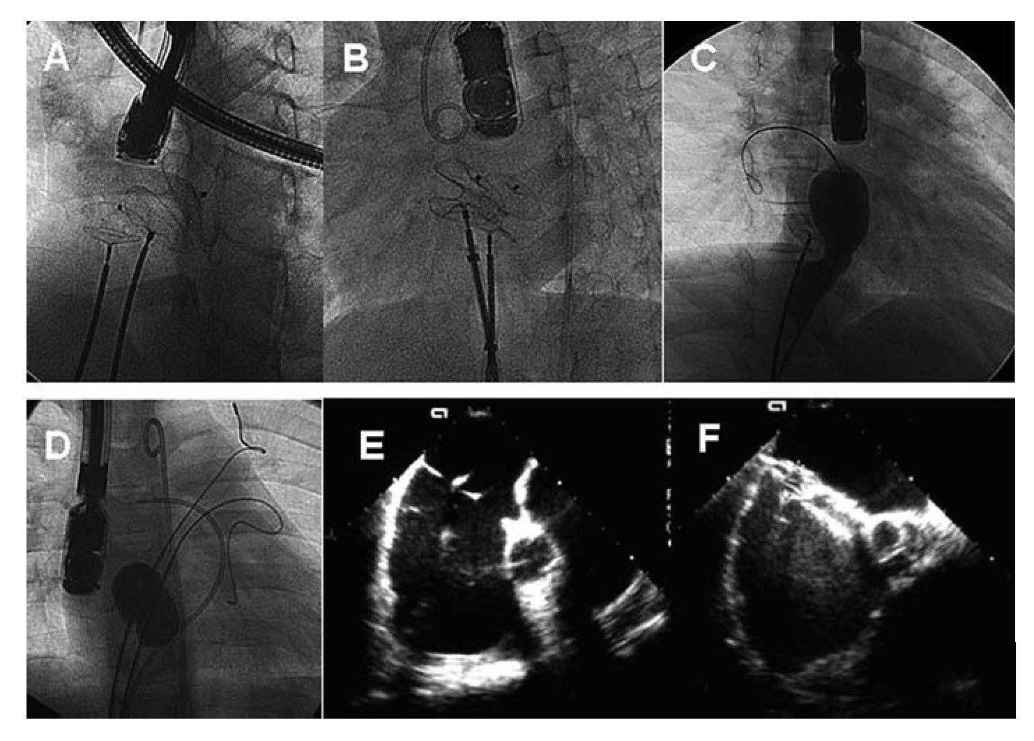 Monitoring Percutaneous Closure of Interatrial Communications: Viewing ...