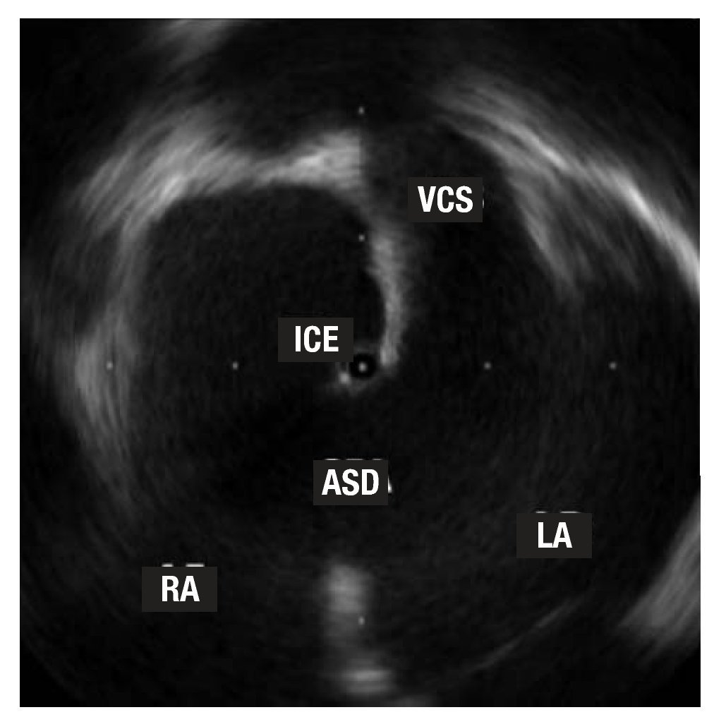 Intracardiac Echocardiography and Percutaneous Closure of Atrial Septal ...
