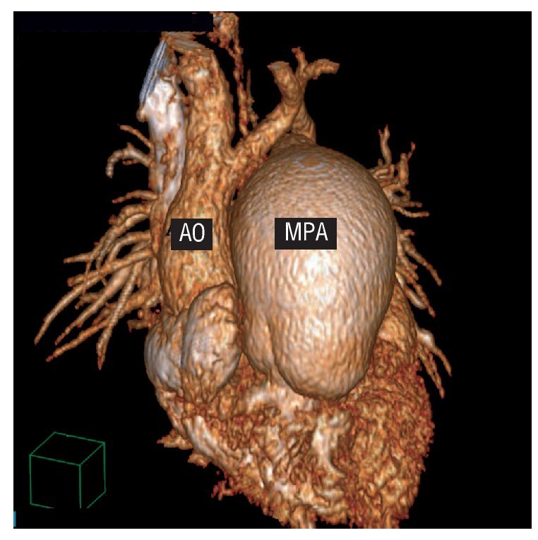 Interrupted Aortic Arch | Revista Española de Cardiología