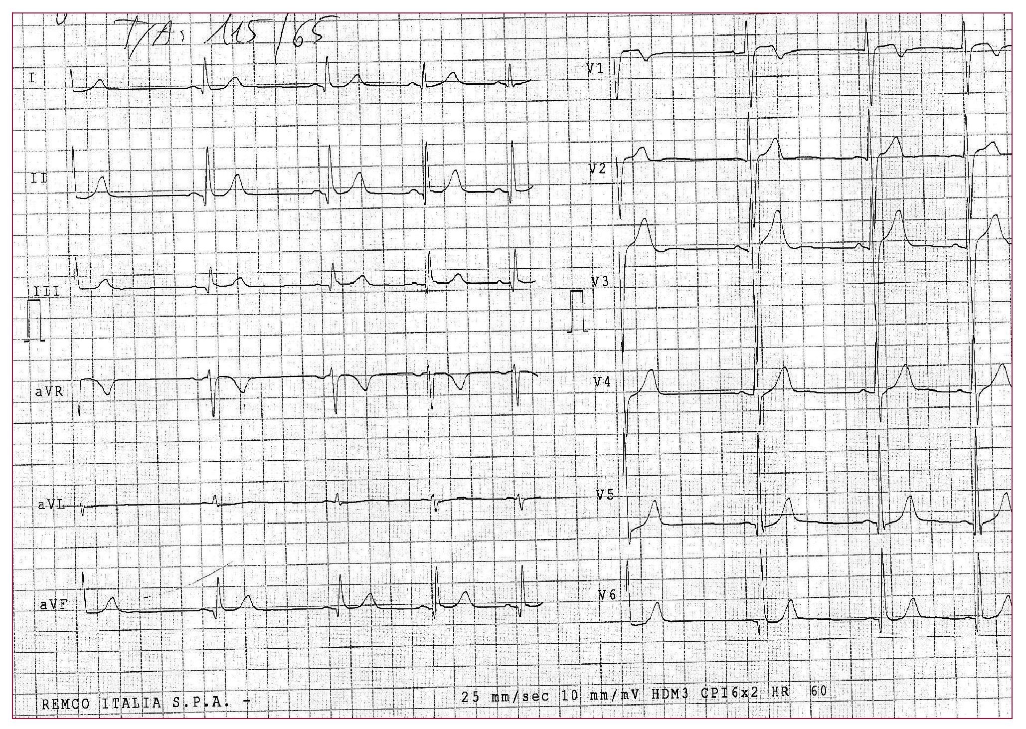 Electrocardiography and Posterior Wall Infarction: Has the Enigma Been Solved? | Revista ...
