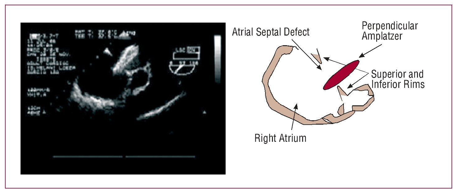 Correction of the Perpendicular Positioning of the Amplatzer Device ...