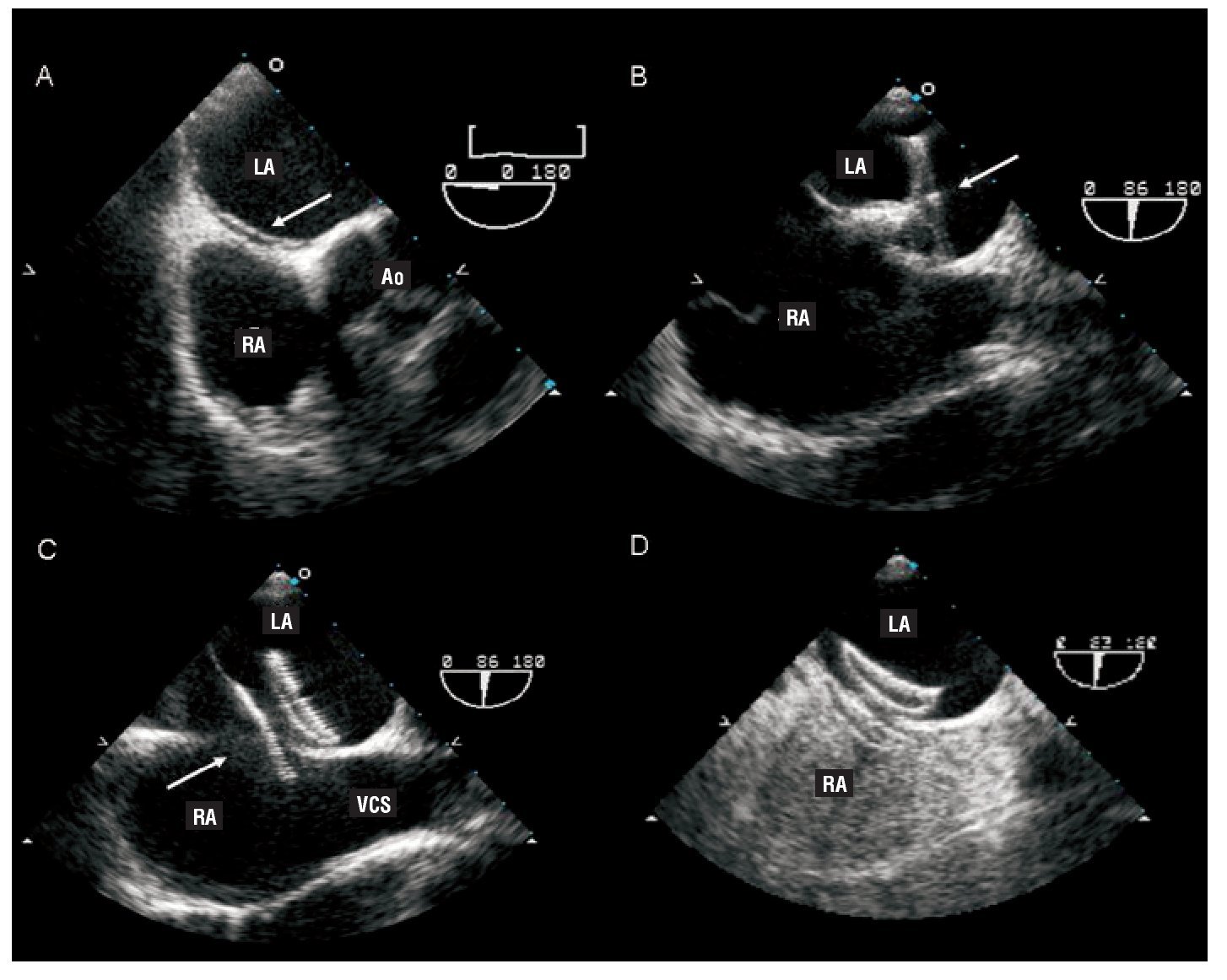 Patent Foramen Ovale: Current State of the Art | Revista Española de ...