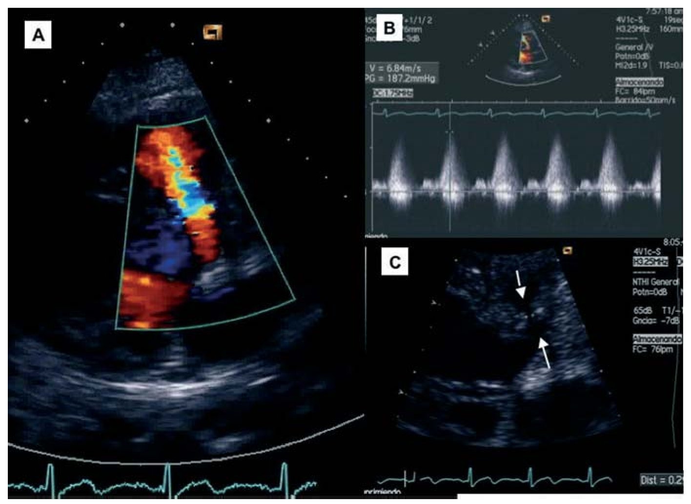 The Pressure Recovery Phenomenon in An Interventricular Septal Defect ...