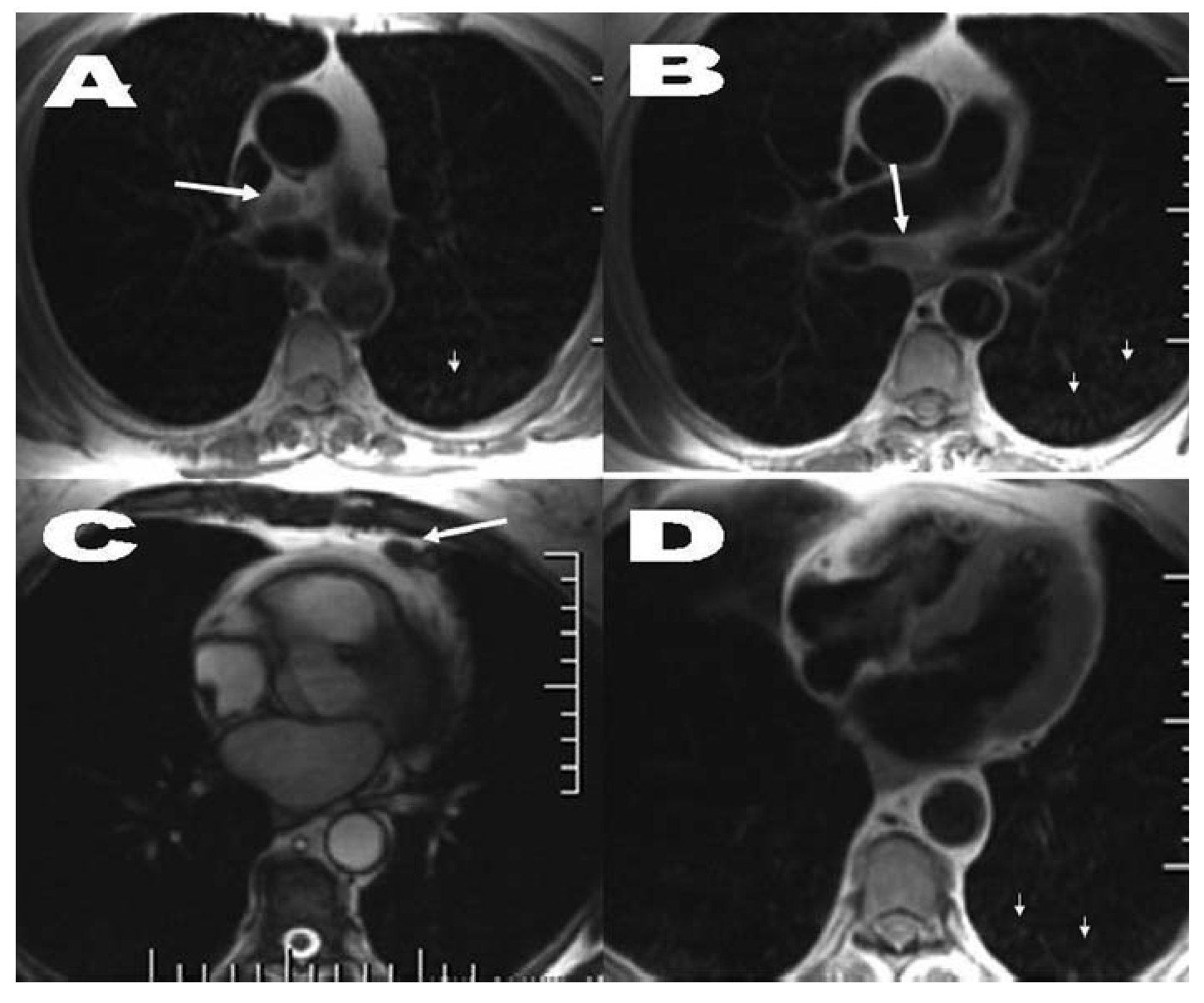 Cardiac Sarcoidosis: Diagnosis by Contrast-Enhanced Magnetic Resonance ...