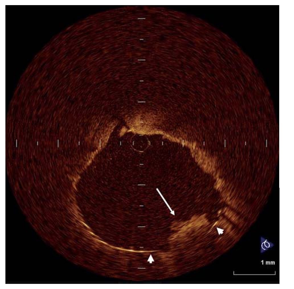 Optical Coherence Tomography. Initial Experience in Patients Undergoing ...
