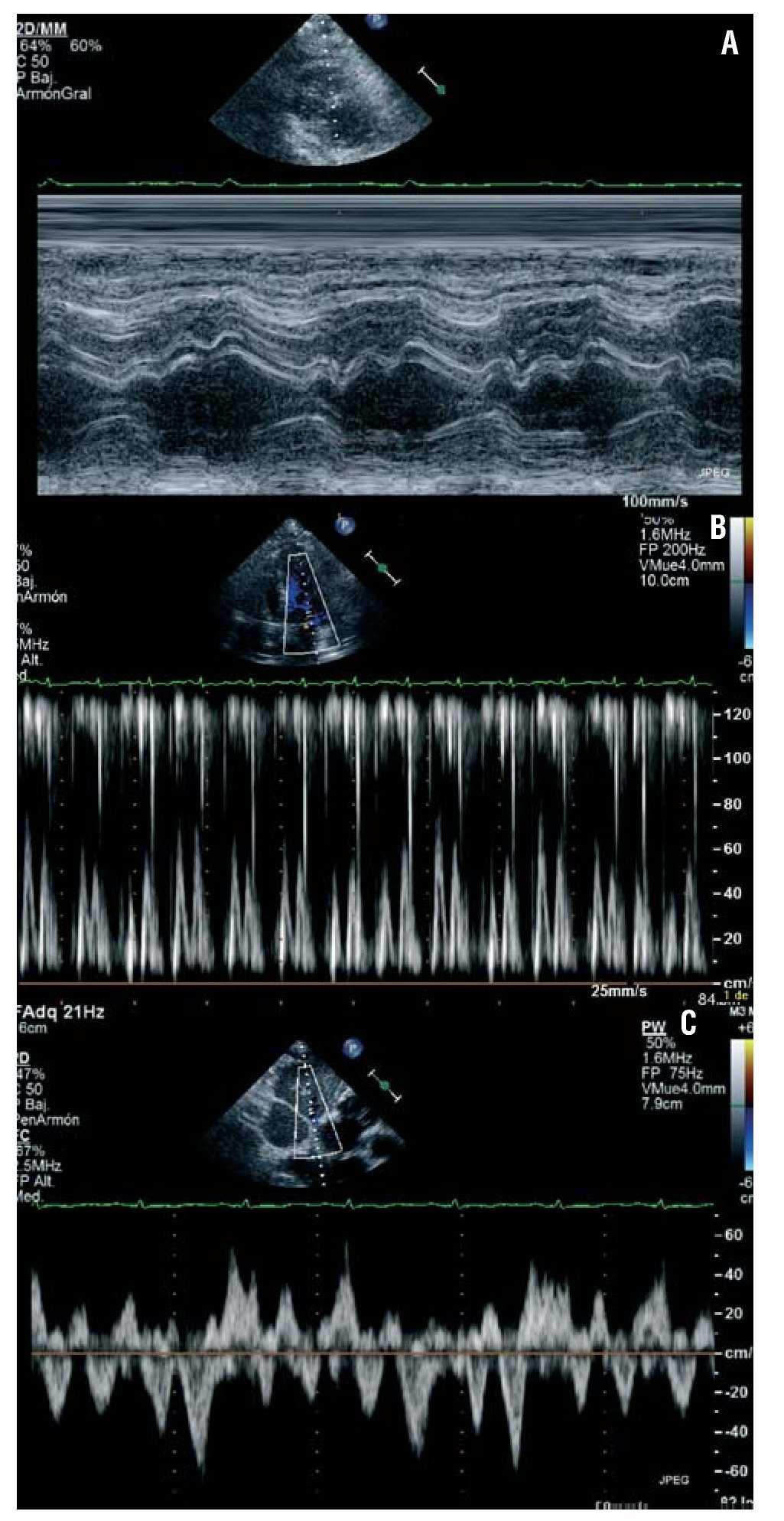 Transient Cardiac Constriction With Severe Heart Failure | Revista ...