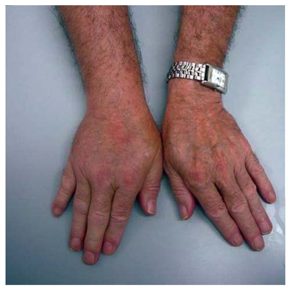 mTOR Inhibitors and Unilateral Edema | Revista Española de Cardiología