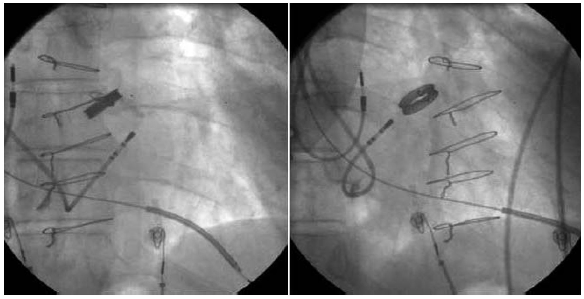 Cardiac Resynchronization Therapy and Valvular Cardiomyopathy After ...