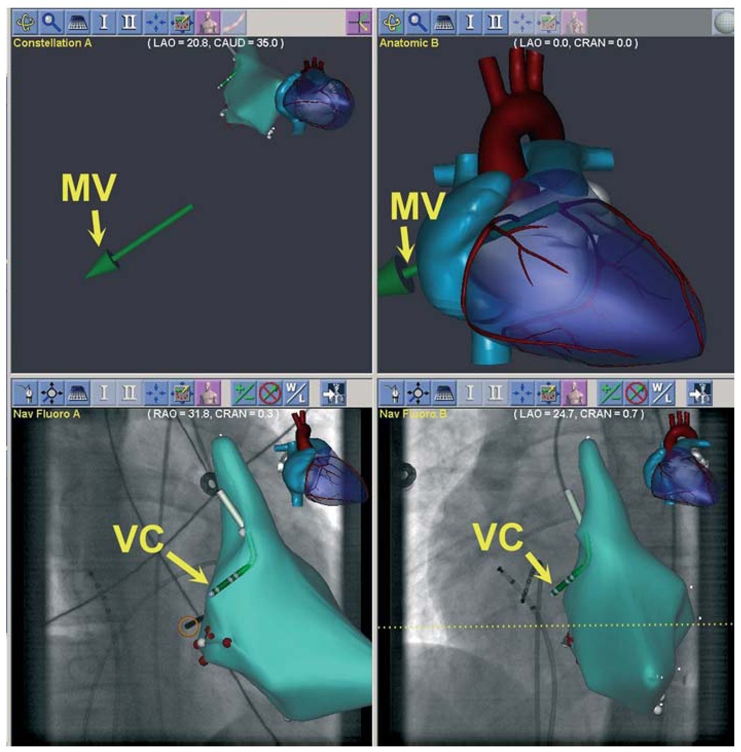 Ablation of Idiopathic Left Ventricular Tachycardia Using Remote ...