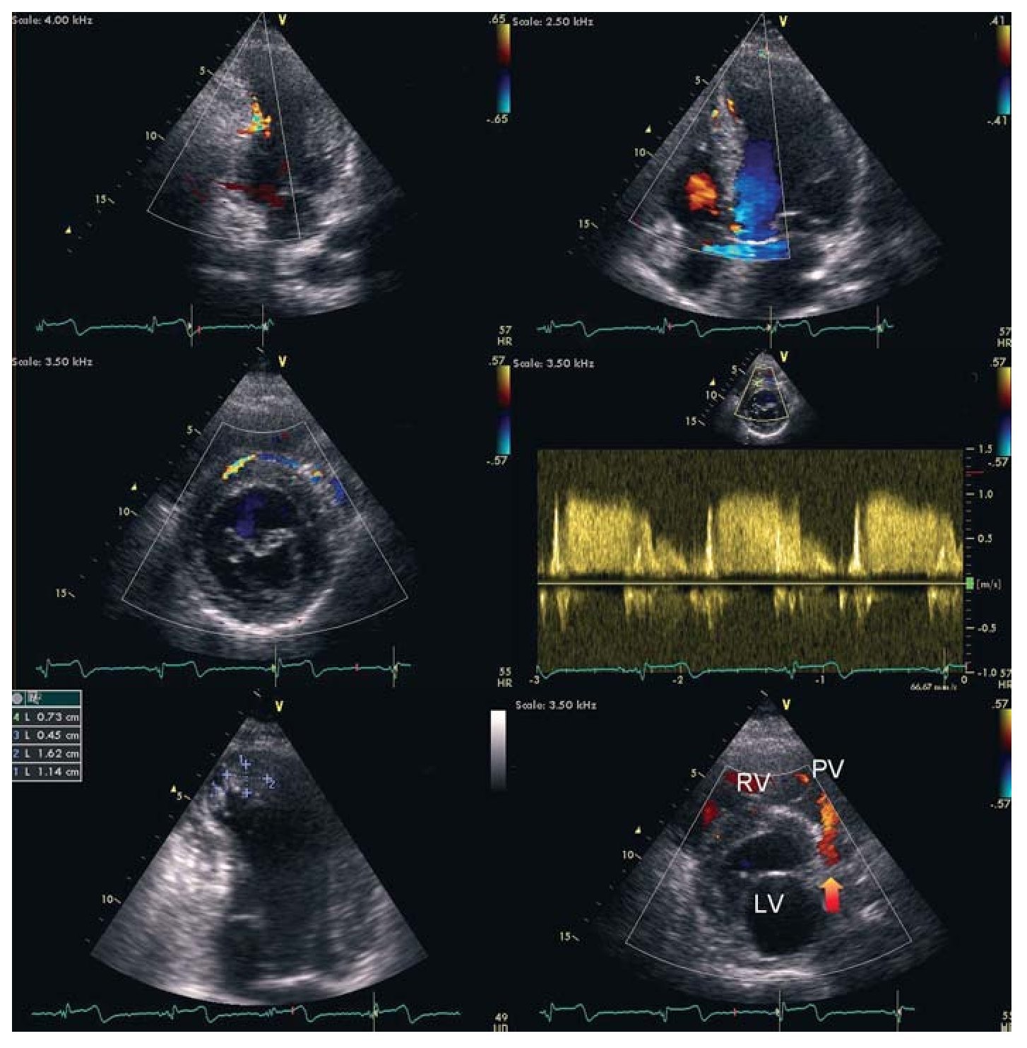 Anomalous Origin of the Left Coronary Artery: the Rare Coincidence of ...