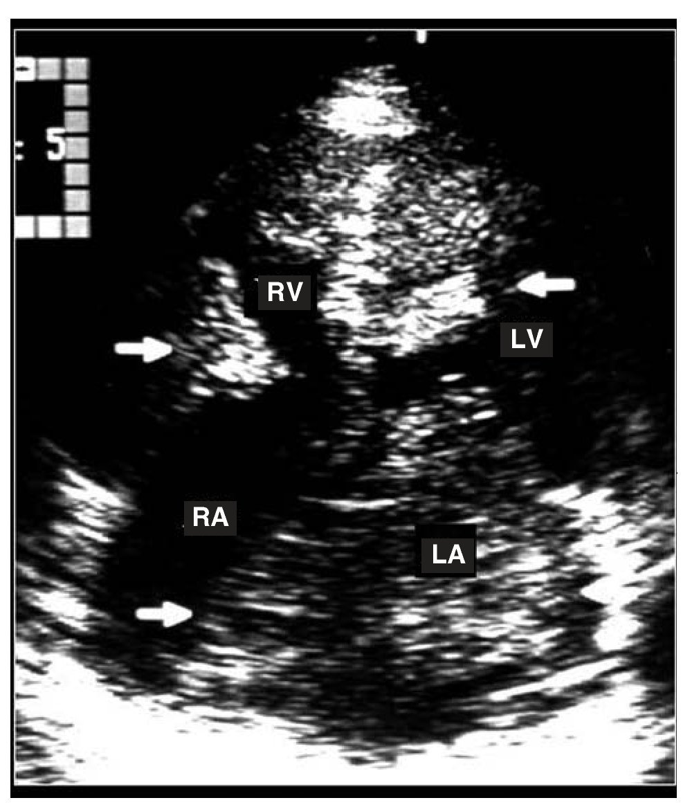 Cardiac Myxomas and the Carney Complex | Revista Española de Cardiología