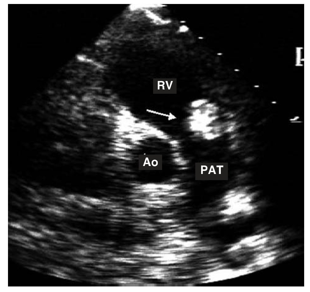 Cardiac Myxomas and the Carney Complex | Revista Española de Cardiología