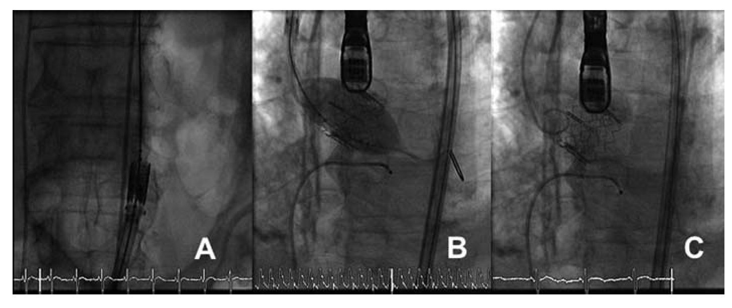 Percutaneous Implantation of Aortic Valve Prosthesis in Patients With ...