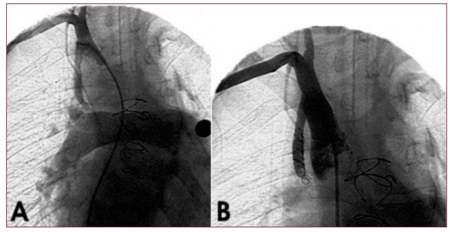 Percutaneous Closure of Blalock-Taussig Shunts Using Gianturco Coils ...