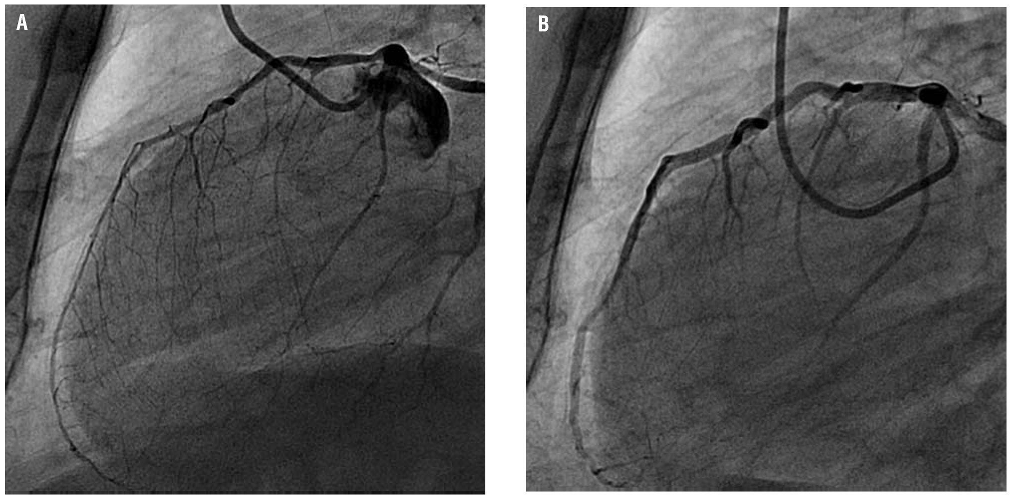 Thyrotoxicosis-Induced Vasospastic Angina | Revista Española de Cardiología