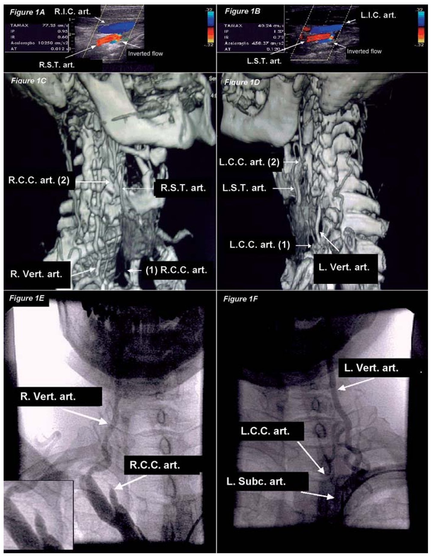 A 53-Year-Old Male With Bilateral Carotid Occlusion and a Functionally ...