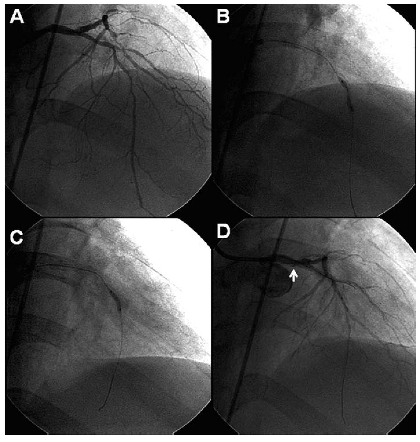 AngioSculpt PTCA Balloon Entrapment DuringDilatation of a Heavily ...