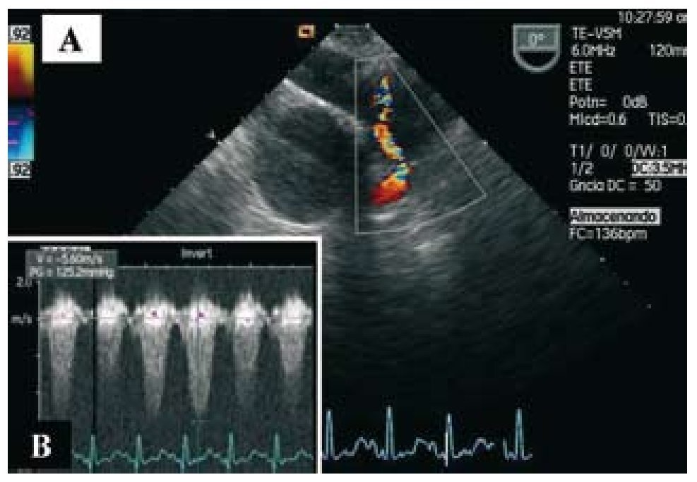 Endocarditis With Occlusive Vegetation in a Pulmonary Homograft ...