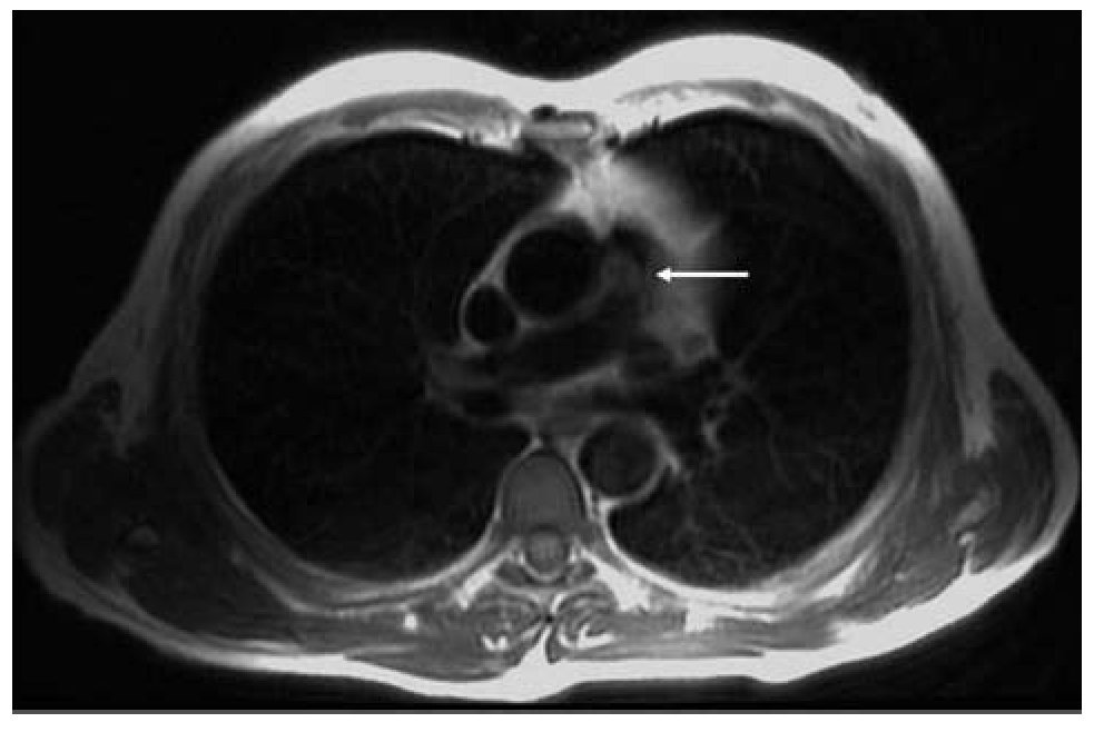 Endocarditis With Occlusive Vegetation in a Pulmonary Homograft ...