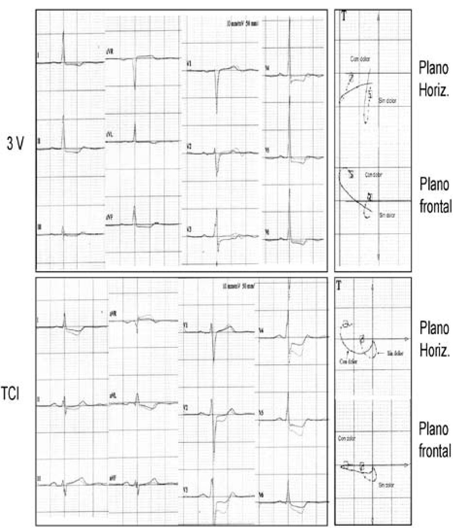 Electrocardiographic Diagnosis of Left Main Coronary Artery Occlusion ...
