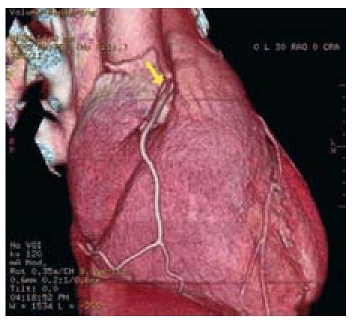 Where Does the Right Coronary Artery Originate? | Revista Española de ...