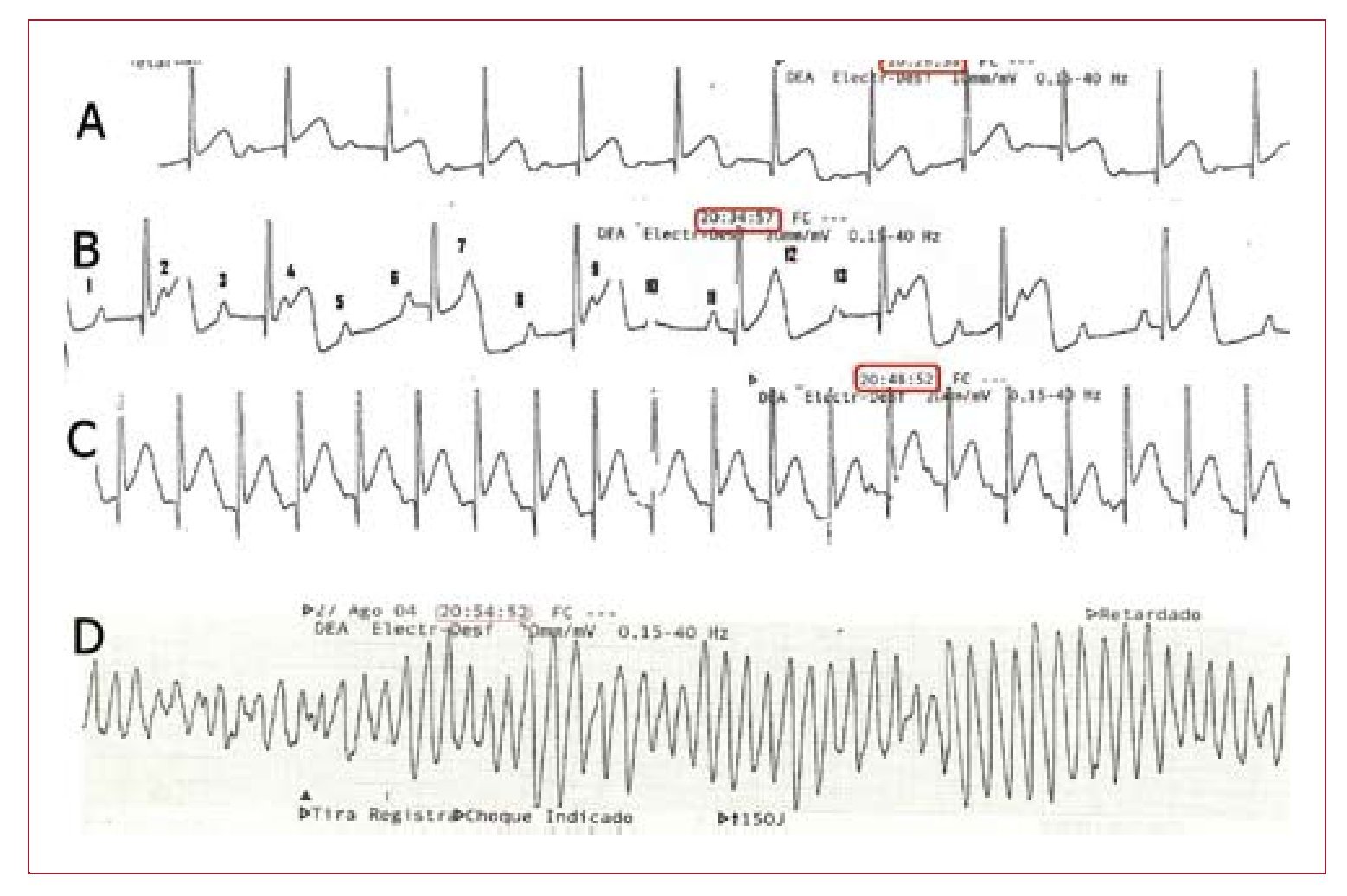 Current Role of Electrocardiography in Acute Ischemic Syndromes: Is It ...