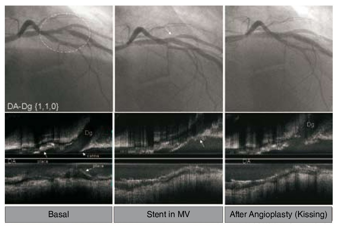 Percutaneous Coronary Intervention in Bifurcation Lesions. Does ...