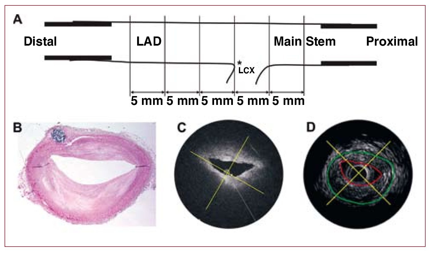Quantitative Ex Vivo and In Vivo Comparison of Lumen Dimensions ...