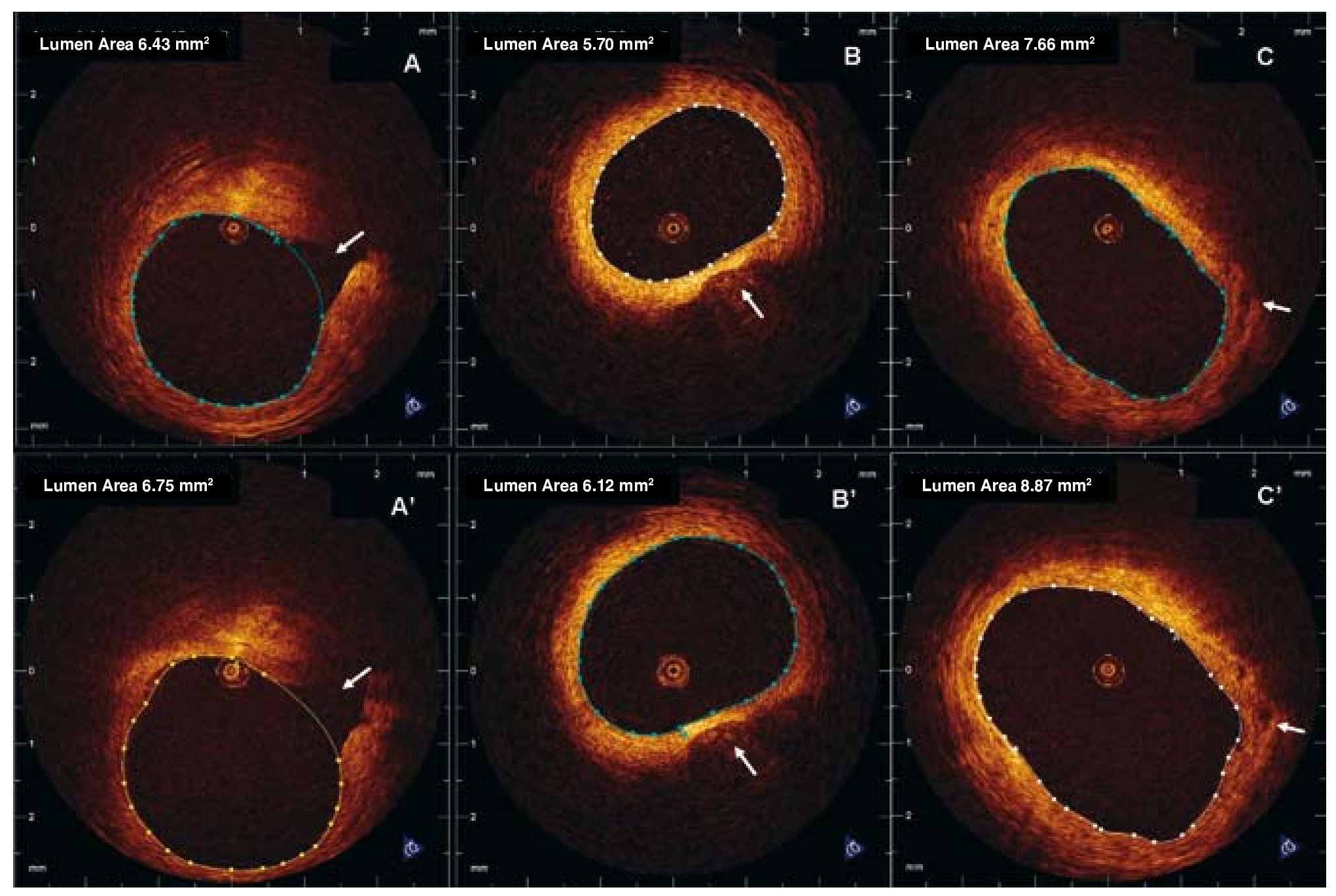 Quantitative Ex Vivo and In Vivo Comparison of Lumen Dimensions ...