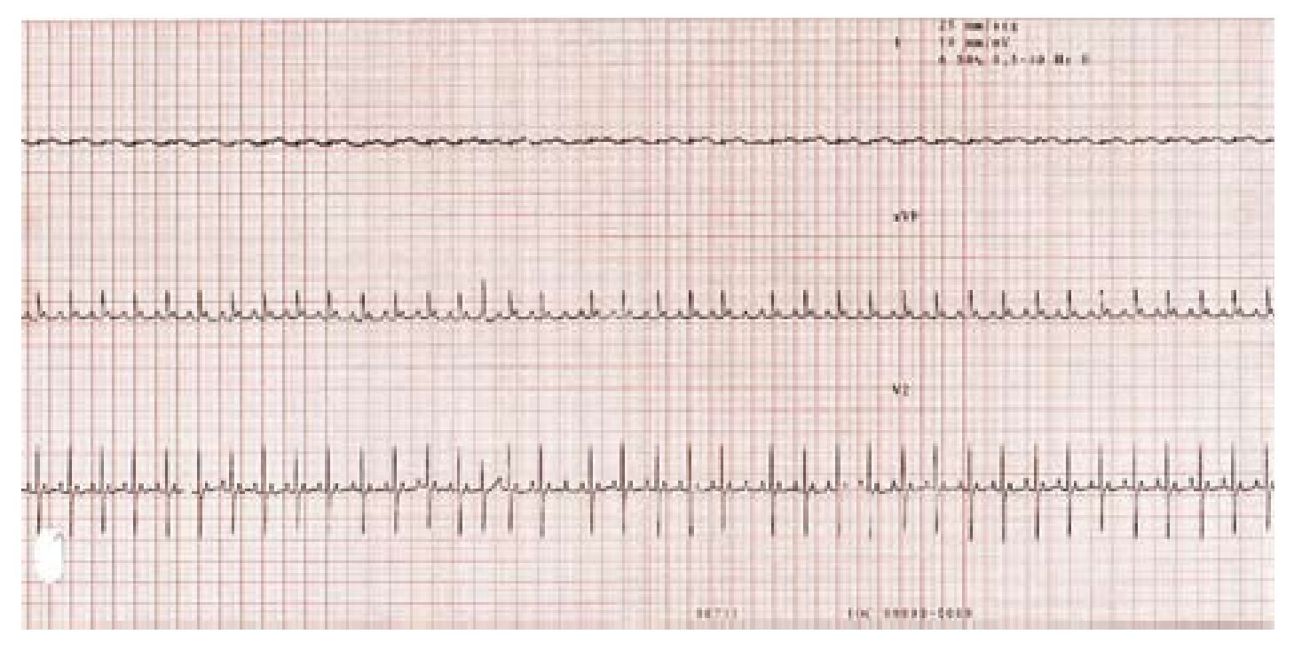 Transient Atrial Flutter in Premature Infants | Revista Española de ...