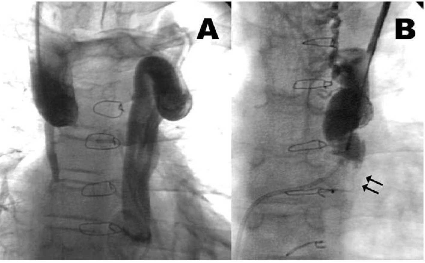 Percutaneous Embolization of Vascular Fistulas Using Coils or Amplatzer ...