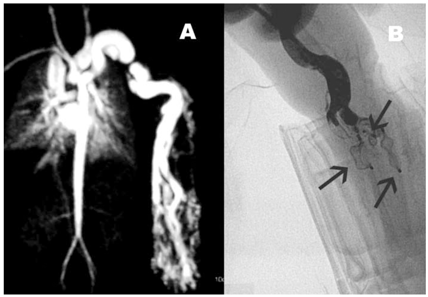 Percutaneous Embolization of Vascular Fistulas Using Coils or Amplatzer ...