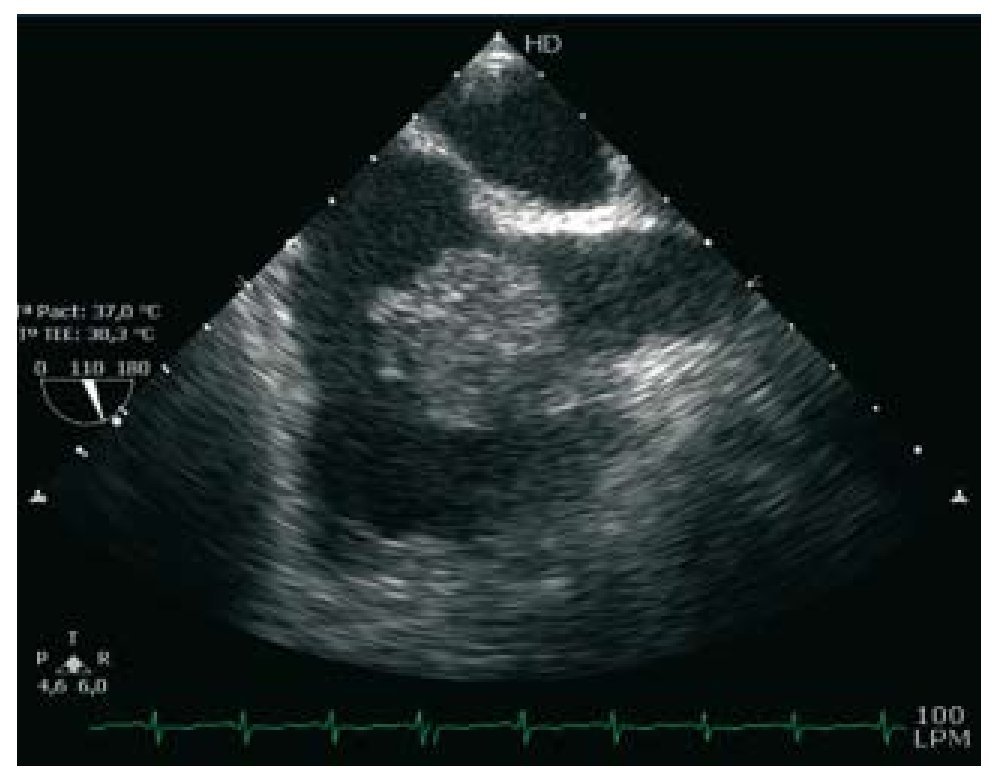 Clinical Variations of Cardiac Sarcoma | Revista Española de Cardiología