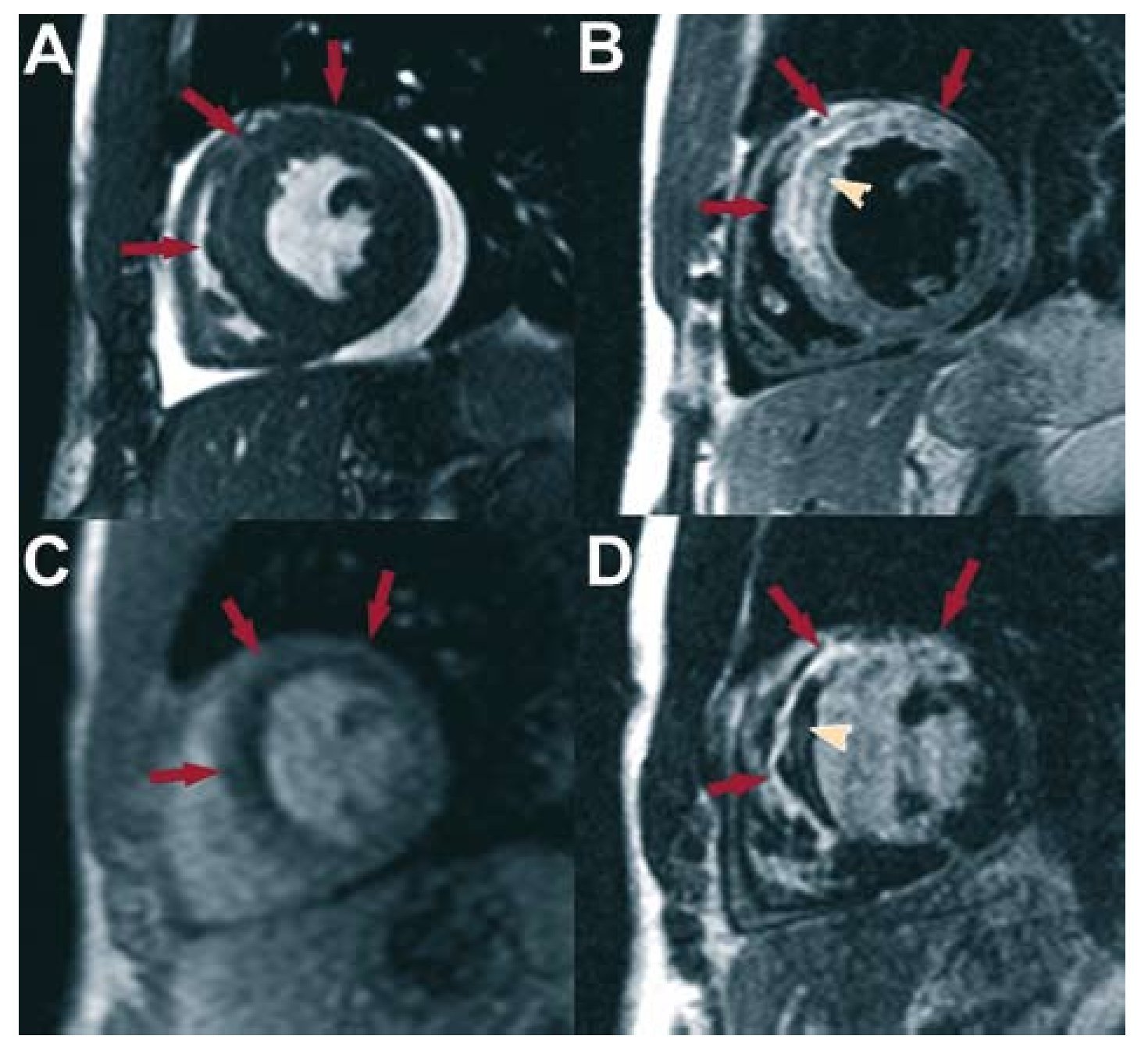 Towards the Complete Characterization of Myocardial Infarcts by ...