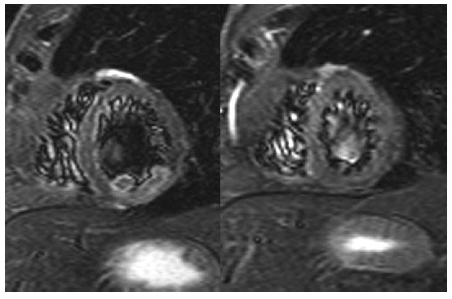 Cardiac Magnetic Resonance Evaluation of Edema After ST-Elevation Acute ...